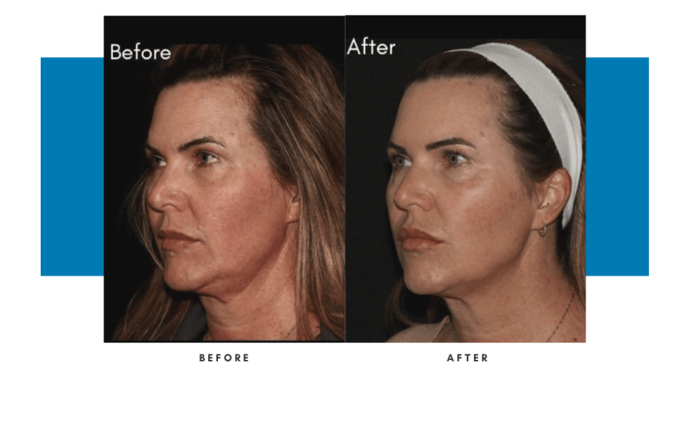 Emface | Clinical Aesthetics